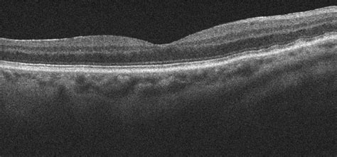 Peaks Of Hyperreflectivity Optocase