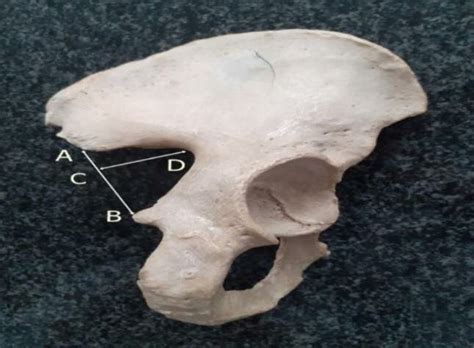 Dimensions Of The Great Sciatic Notch Aposterior Inferior Iliac Spine