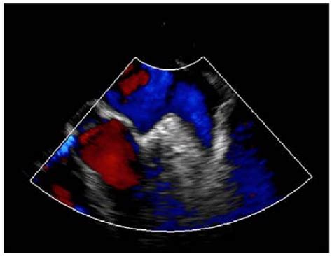 Transthoracic Color Doppler Echocardiogram Of The Patient Aged 70 Years