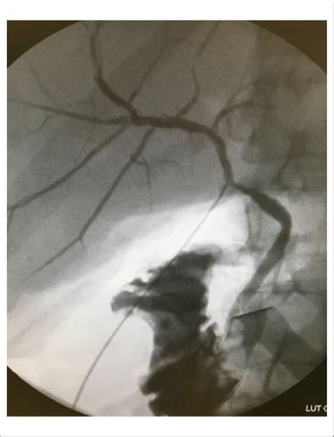 Intraoperative Cholangiogram Through The Cystic Duct Stump Download