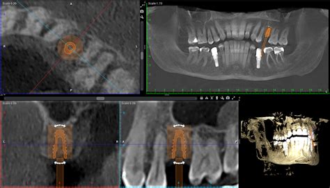 Dental Implant Timeline — Teuscher Legacy Dental