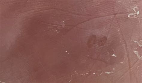 발바닥에 물집 지식in