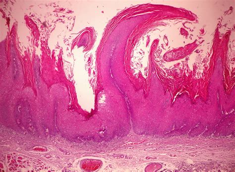 Hairy Leukoplakia Histology Oral Proliferative Verrucous Leukoplakia