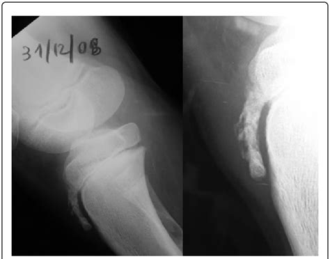 A Right OSD In A Years Old Babe OH Vitamin D Ng Ml Download Scientific Diagram