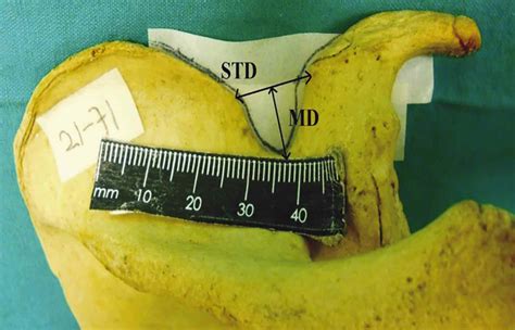 Dimensions Taken Of The Suprascapular Notch Std Superior Transverse