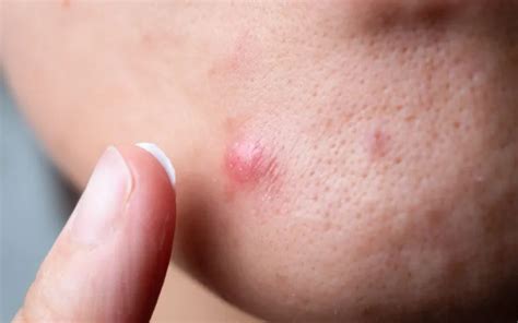 Pimples On Chin Hormonal Factors And Effective Treatments