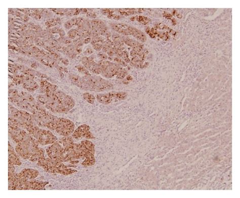 The Tumor Cells Expressing Strong Immunoreactivity For Neuron Specific Download Scientific