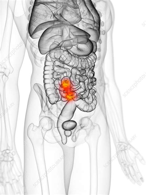 Intestinal Cancer Illustration Stock Image F0384278 Science