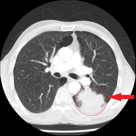 What Is Lung Involvement In Ct Scan At Gail Kristi Blog