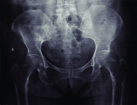 Abnormal Pelvic X Ray Re Prt Acute Destructive Hip Septic Arthritis In