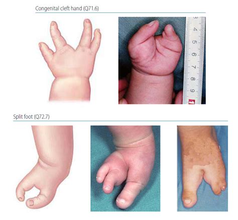 Congenital Limb Deficiency