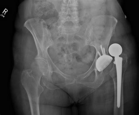 Anteroposterior View Radiograph Of The Pelvis Demonstrating Dislocation Download Scientific