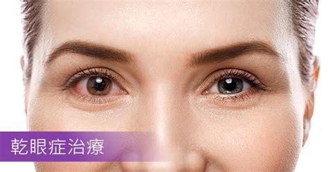 乾眼症治療 博視眼科診所