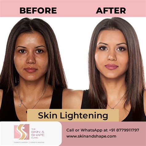 Skin Bleaching Results Celebrities Who Bleached Their Skin Before And