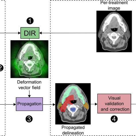 Workflow Of Delineation Propagation From The Planning Ct To Per