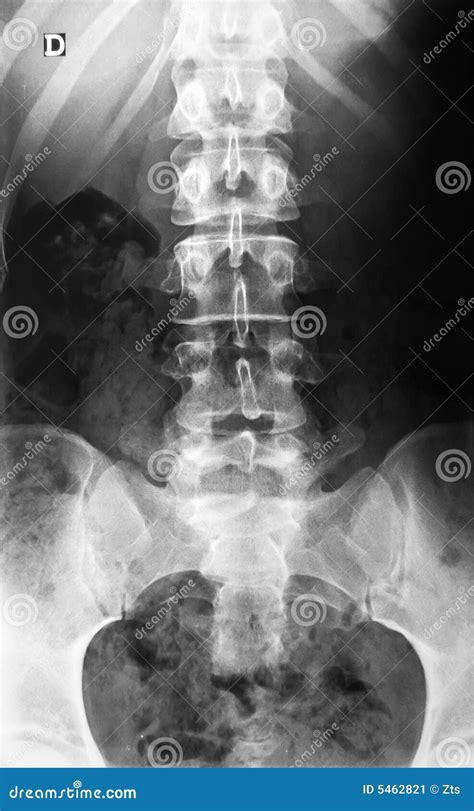 X Ray Of The Spinal Column Stock Image Image Of Body 5462821