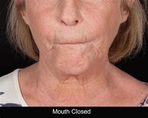 Systemic Scleroderma Face