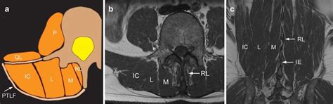 Anatomy Of The Intrinsic Back Muscles Line Diagram Of Axial Section At