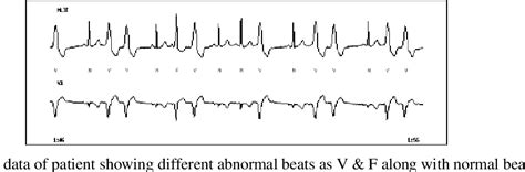 Figure 1 From Ecg Classification And Abnormality Detection Using Cascade Forward Neural Network