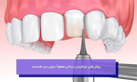تراش دندان؛ چرا در لمینت، دندان را می‌تراشند دندانپزشکی شبانه روزی تاج