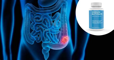 Sodium Butyrate In Colon Cancer Role Cause And Benifits