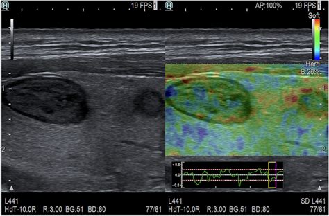 Two Hypoechogenic Nodules In The Right Thyroid Lobe One Partially