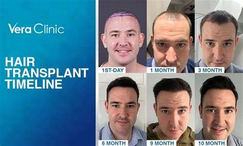 Hair Transplant Timeline A Journey To Confidence