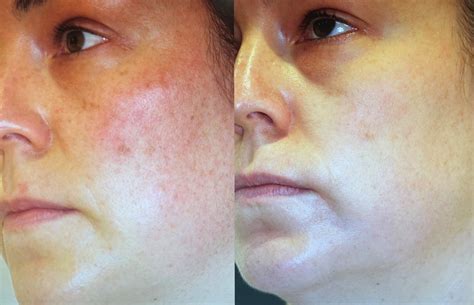 Rosacea Treatment Face And Eye Aesthetics