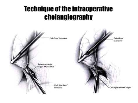 Postcholecystectomic Syndrome Ppt Download
