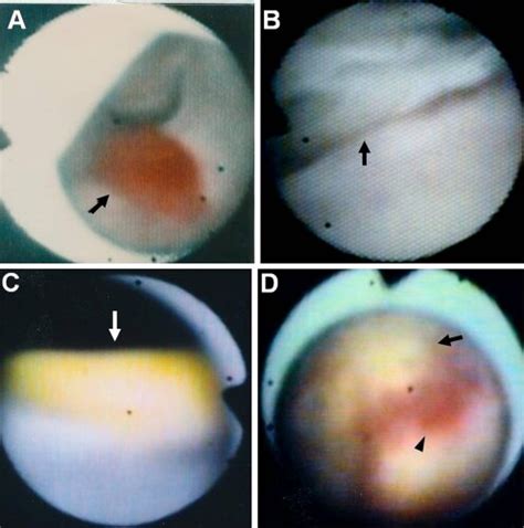 Color Of Left Ventricular Thrombi Lvt A Red Lvt Arrow In A