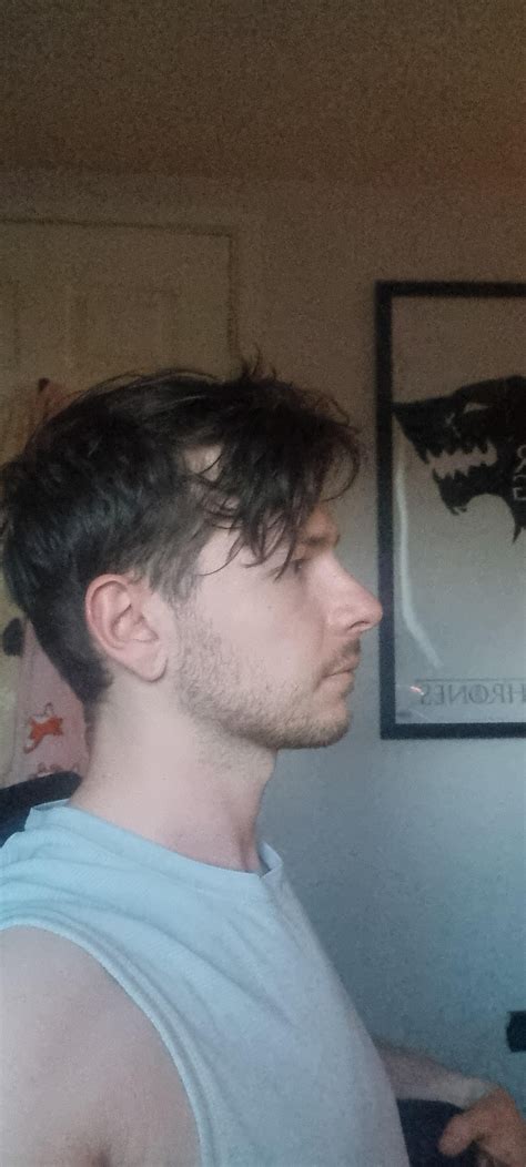 Post Jaw Surgery Overbite Flared Teeth Sfs R Jawsurgery