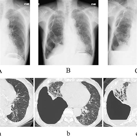 Figure4 Pleura Course After The Open Window Thoracostomy The Download Scientific Diagram