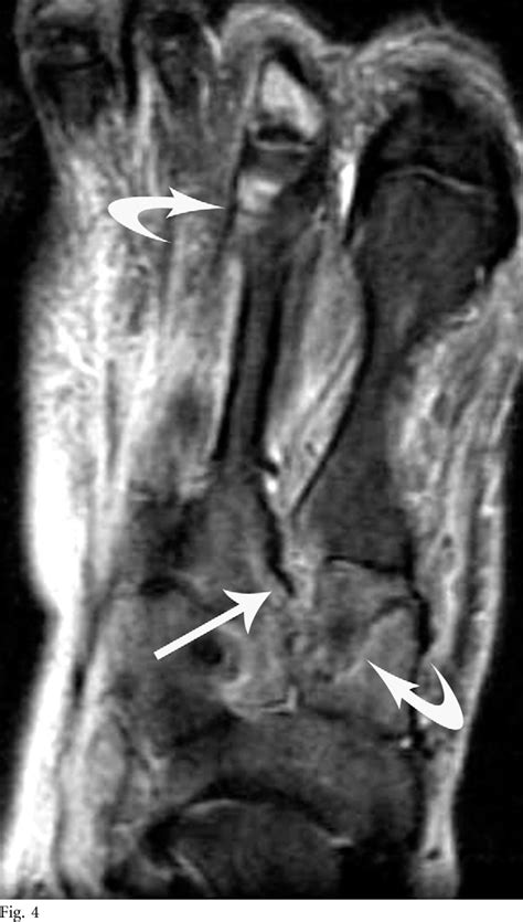 Figure 1 From Prediction Of Midfoot Instability In The Subtle Lisfranc