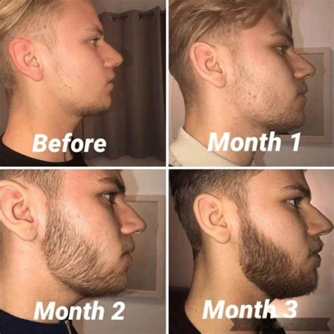Beard Roller Activate New Growth Microneedle Bald And Beards
