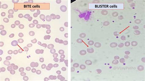 Blister Cells