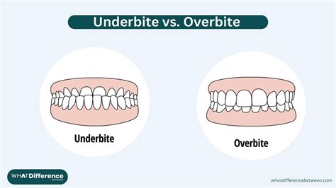 Underbite Vs Overbite Differences Causes And Treatment