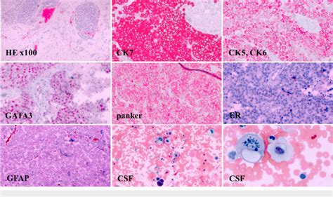 The Pathology Specimen Demonstrates Poorly Differentiated Metastatic Download Scientific