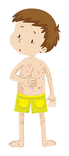 Ringworm Illustrations Royalty Free Vector Graphics And Clip Art Istock