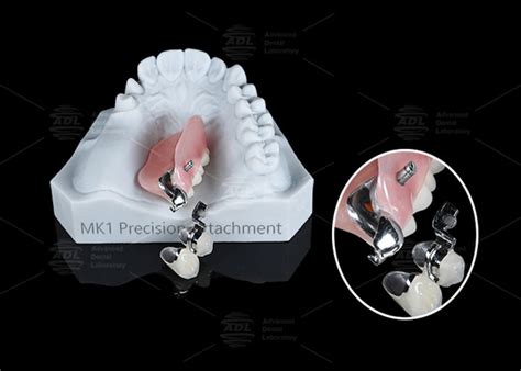 Mk1 Precision Attachment Removable Partial Denture Easy Installation