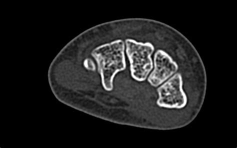 Radiopaedia Case Scaphoid Fracture Dual Energy CT Id Study NC Commons