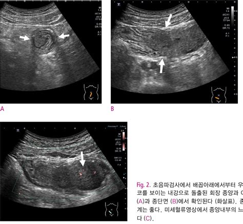 Figure 1 From Inflammatory Fibroid Polyp Of Ileum With Intussusception