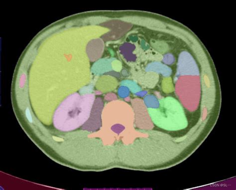 Segment Anything Model Sam 在医疗图像上应用segment Anything In Medical Images Csdn博客