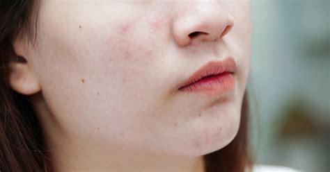 생리 주기 맞춰 올라오는 피부 트러블… 예정일 3일 전부터 ‘이것 하세요