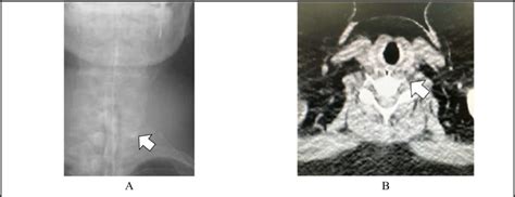 Fluoroscopy And Contrast Computed Tomography Ct Images On Download Scientific Diagram