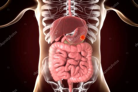 Cáncer De Estómago Ilustración 3d Que Muestra La Anatomía Del Sistema