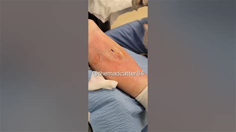 Cellulitis Turned Into Abcess Of The Leg Youtube