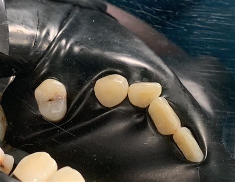 Replacing The Missing Tooth Dr Shanaz Klinik Pergigian Fauziah