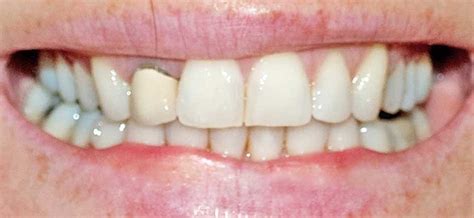 Compliance Compliance Compliance Why Invisalign Compliance Is Key My Invisalign Blog