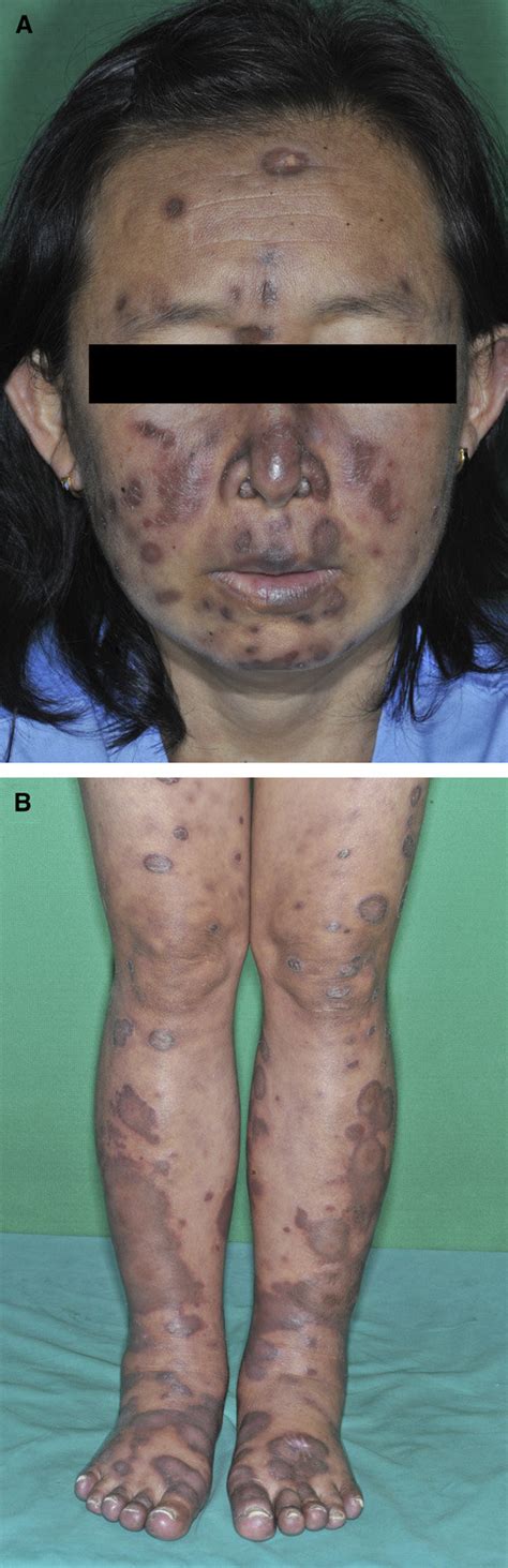 Clinical Features Of Disseminated Cutaneous Leishmaniasis A Diffuse