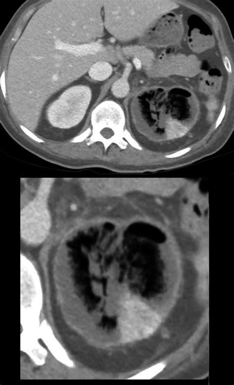 Emphysematous Pyelonephritis The Common Vein
